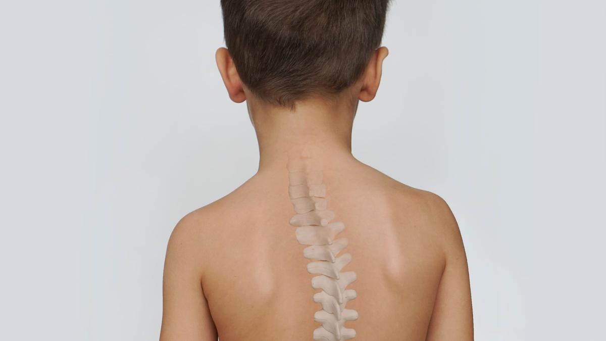 Explaining Spinal Muscular Atrophy (SMA) - The Hindu