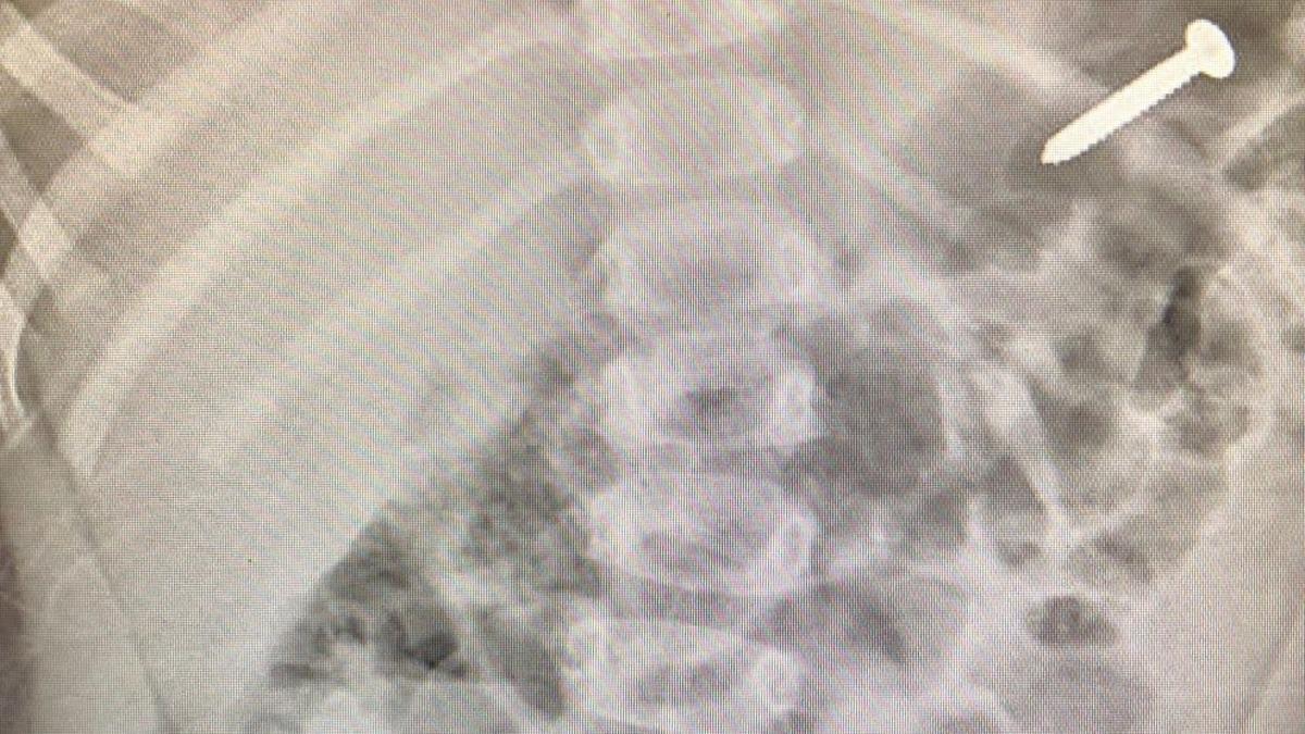 Foreign Body Ingestion (Food Pipe) And Aspiration (Windpipe) In ...