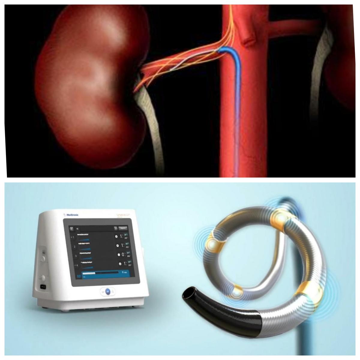 A Novel Percutaneous Treatment for Hypertension: Renal Denervation (RDN ...