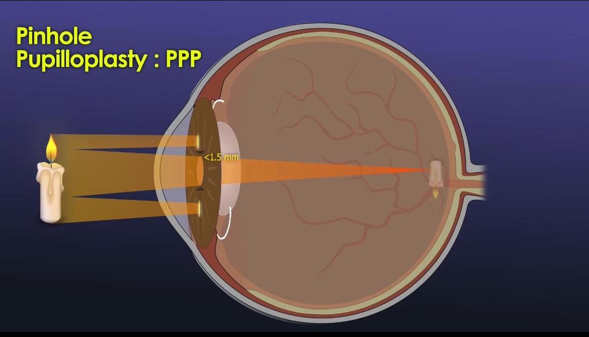 Hole in one: Pinhole pupilloplasty emerges as alternative to corneal ...