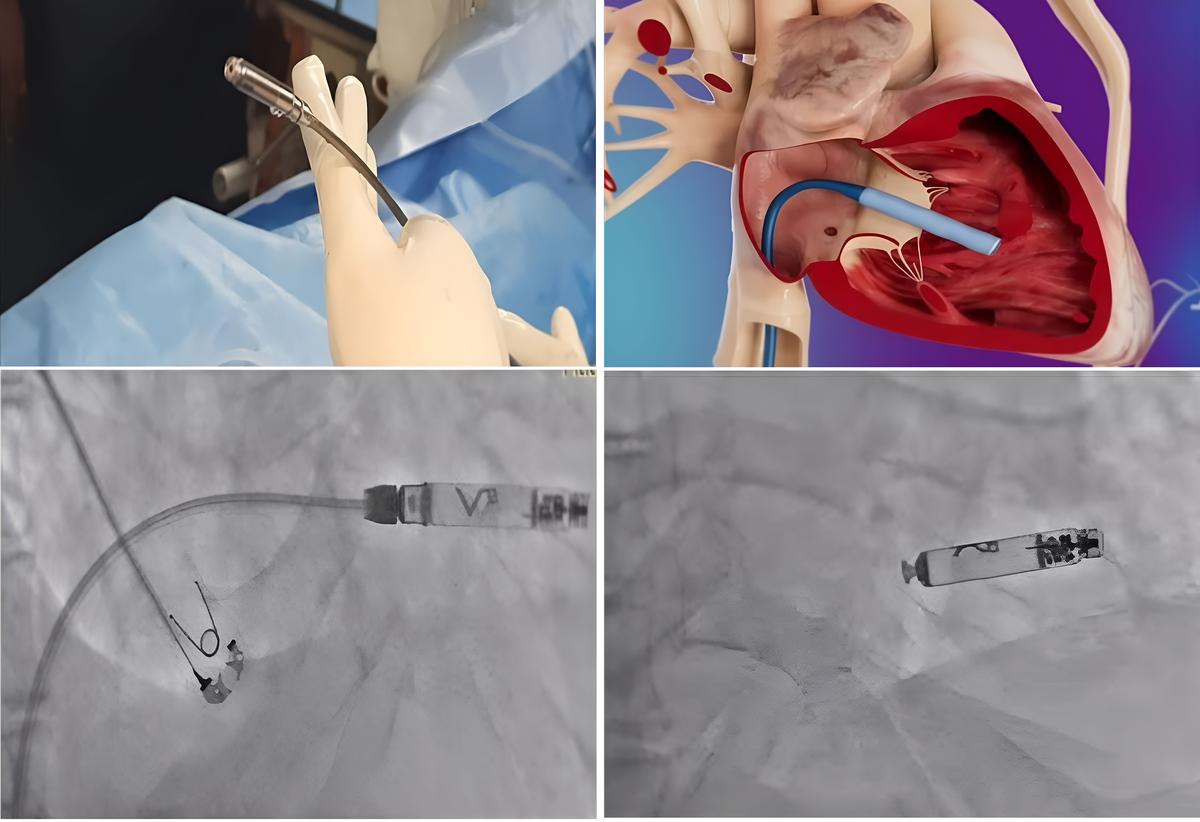 Aveir Leadless Pacemaker: The Latest Innovation in Pacing Therapy ...