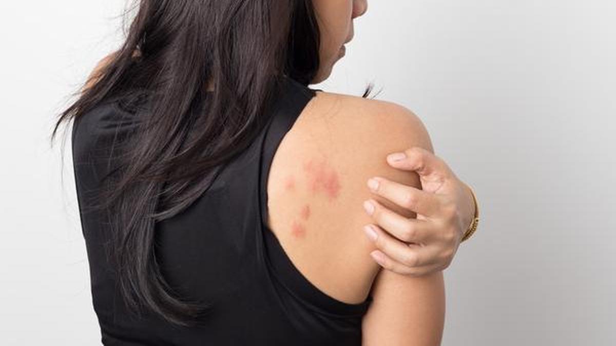 What is it: Keto rash - The Hindu