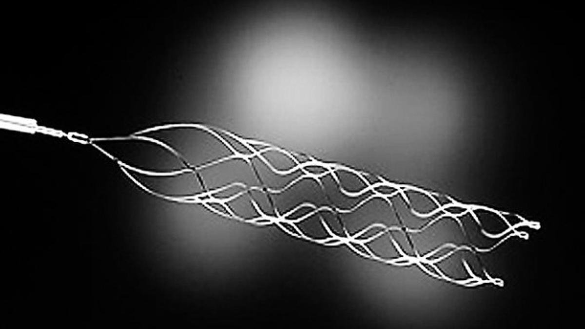 ‘Stents can be used to treat brain strokes’ - The Hindu