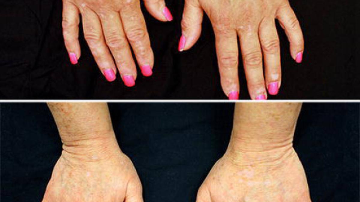 Breakthrough in treating leucoderma - The Hindu