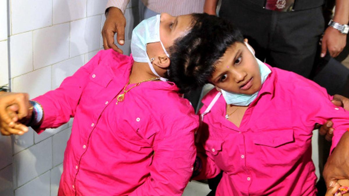 Conjoined twins: TS to seek advice from AIIMS experts - The Hindu