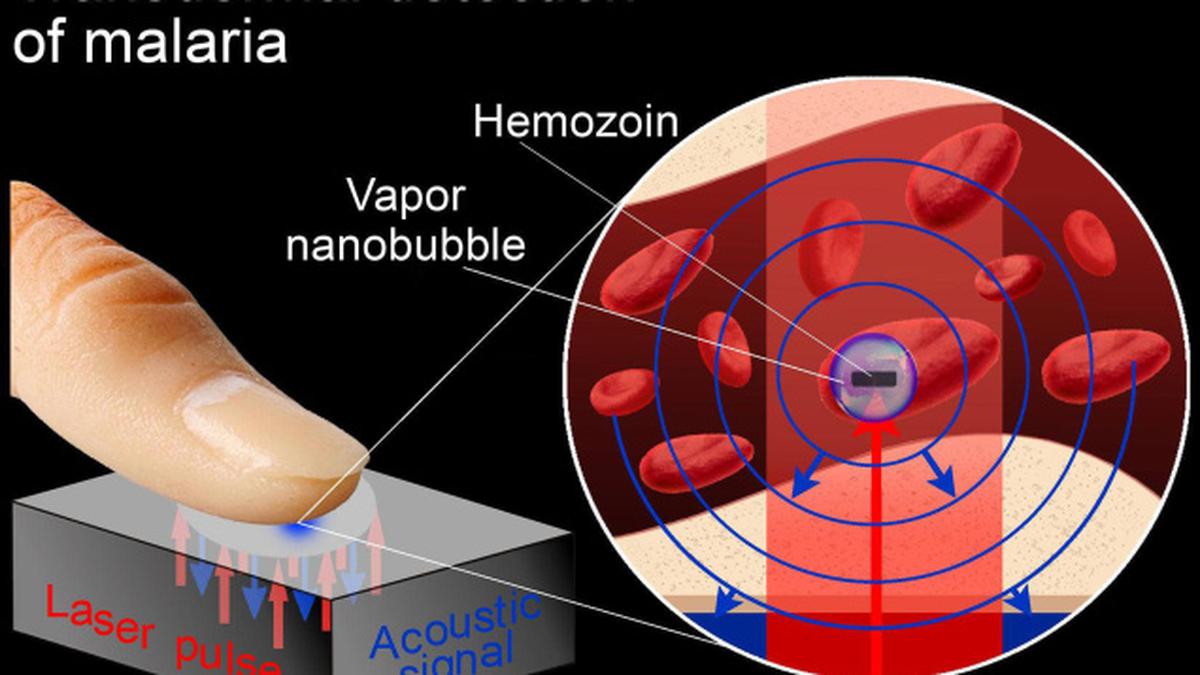 Shining light through skin to diagnose malaria - The Hindu