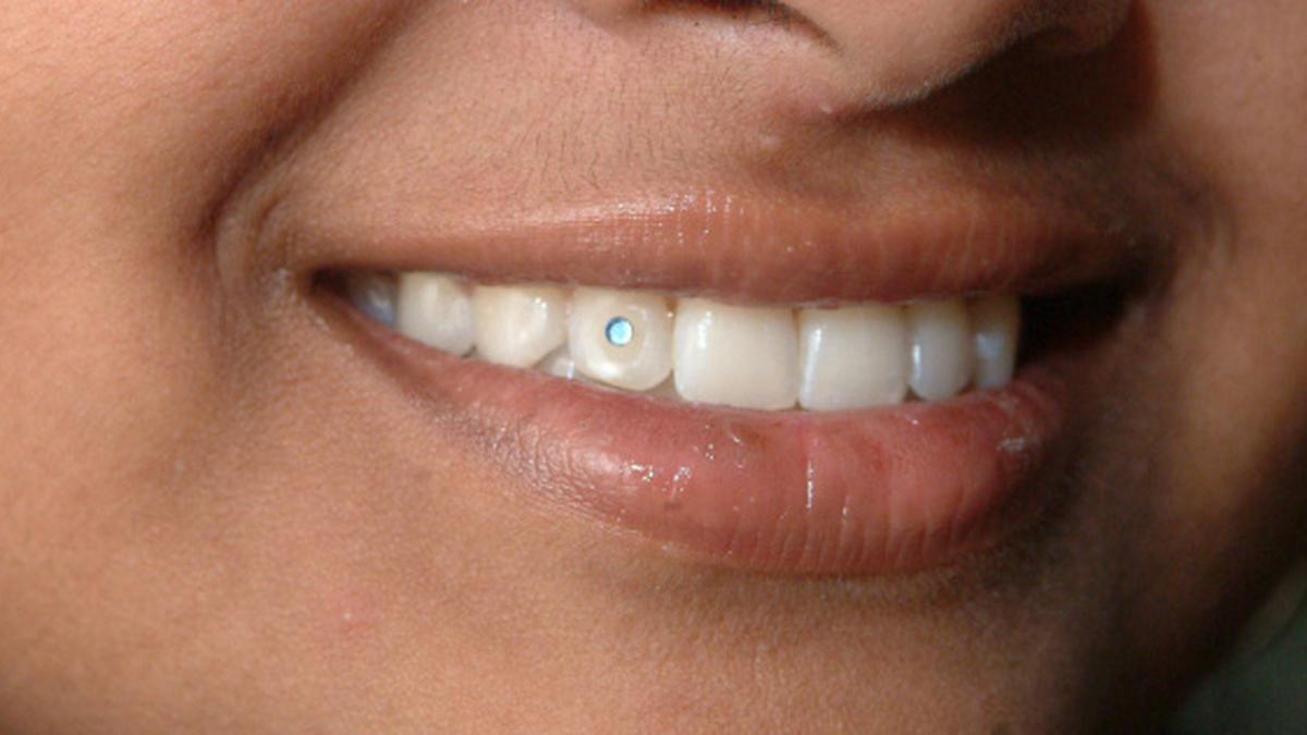 Tooth triumphs - The Hindu