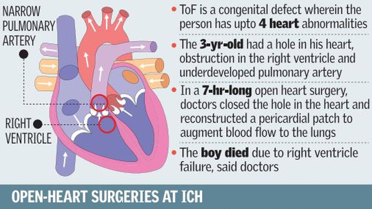 Three-yr-old dies after heart surgery - The Hindu
