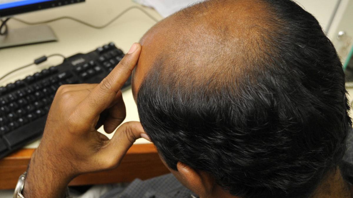 Stem Cells To Cure Baldness The Hindu