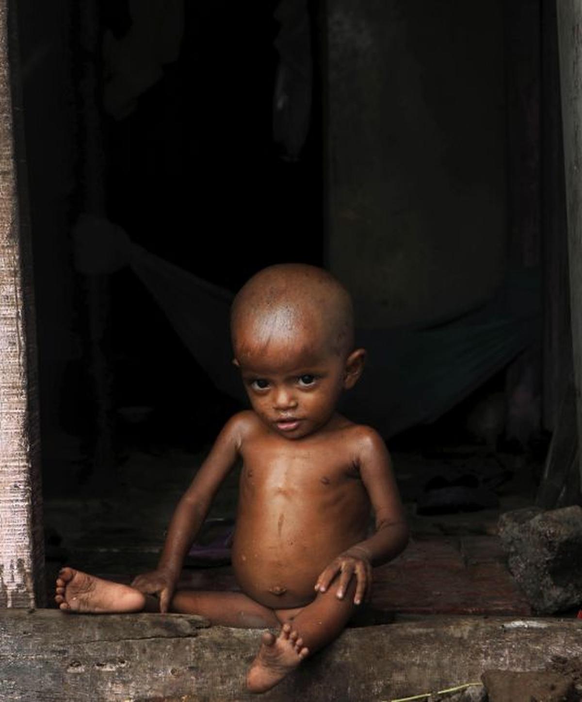 Underweight Children