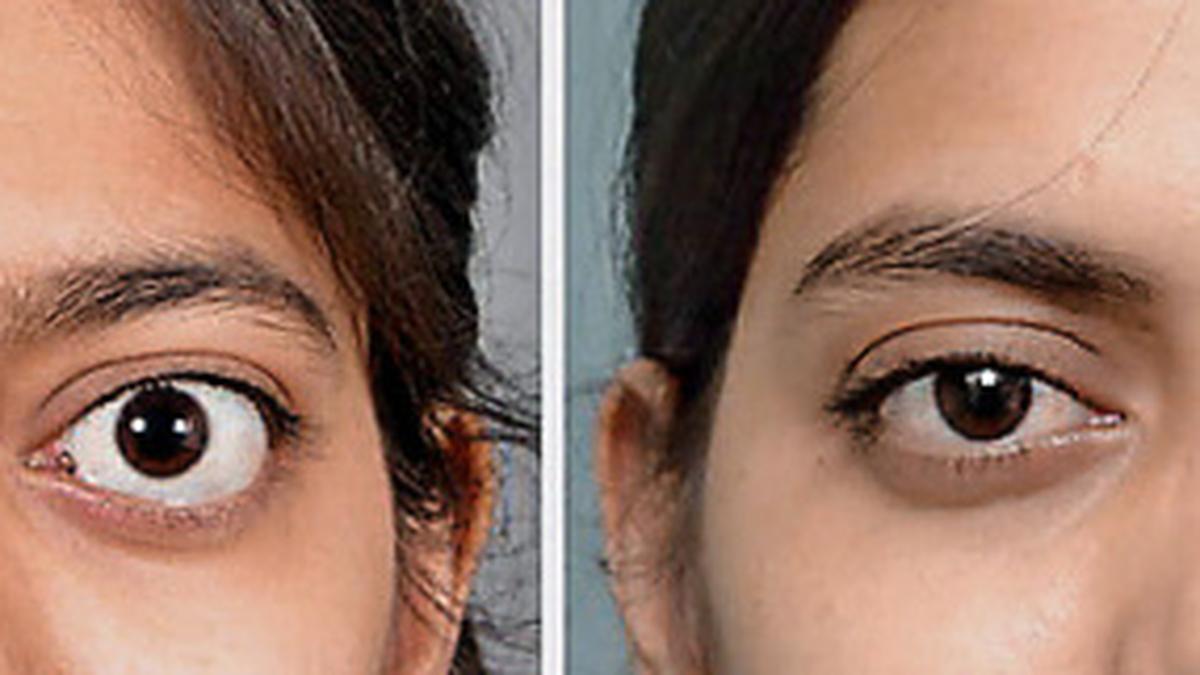 Keyhole surgery to correct bulging eyes - The Hindu
