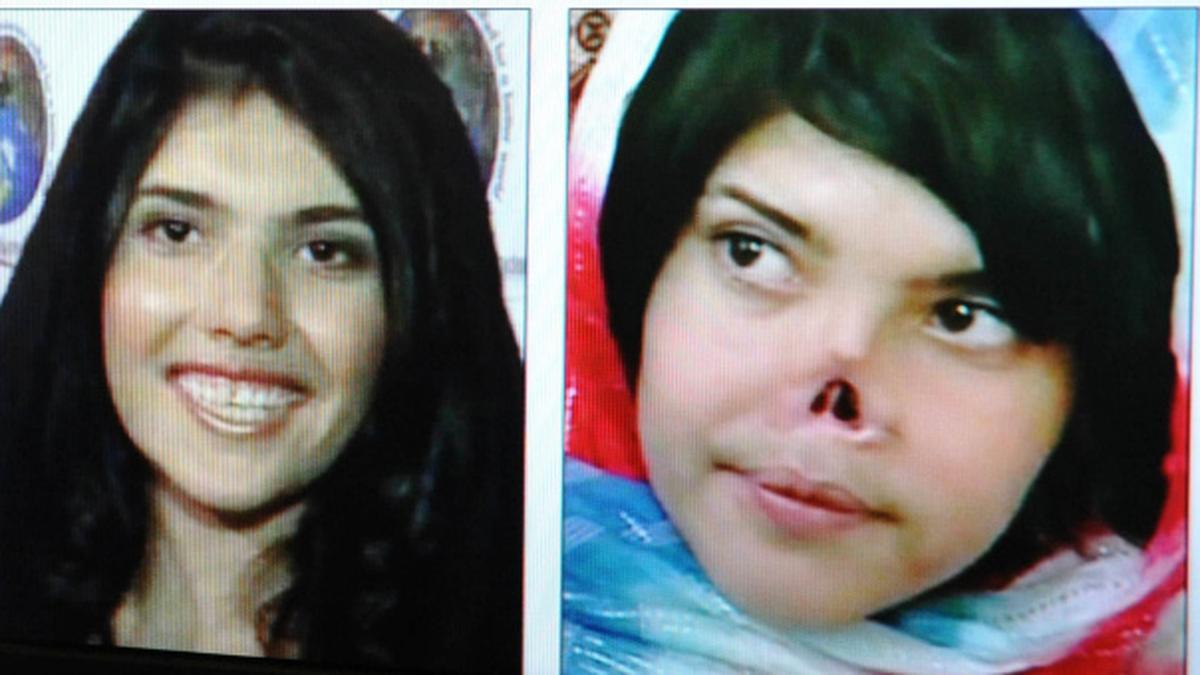 Taliban victim unveils prosthetic nose - The Hindu