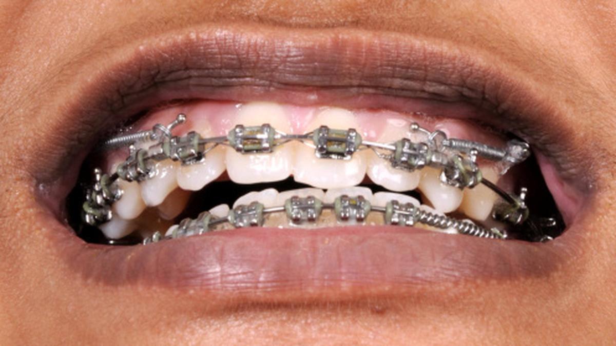 Now, a device that can stop you grinding your teeth - The Hindu