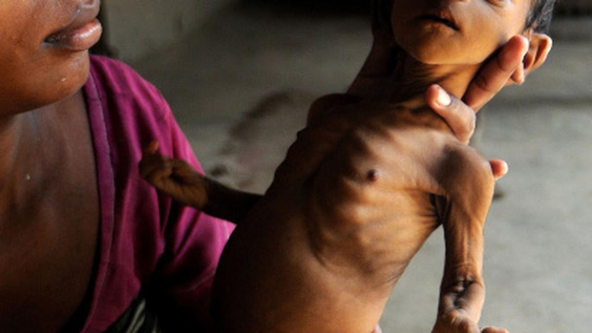 Child undernutrition in India is a human rights issue - The Hindu
