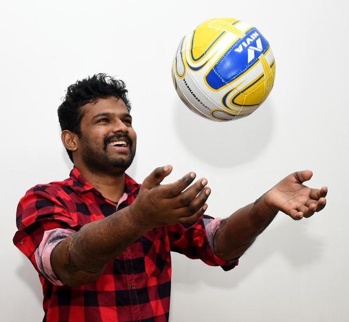 Hand transplant patient going strong - The Hindu