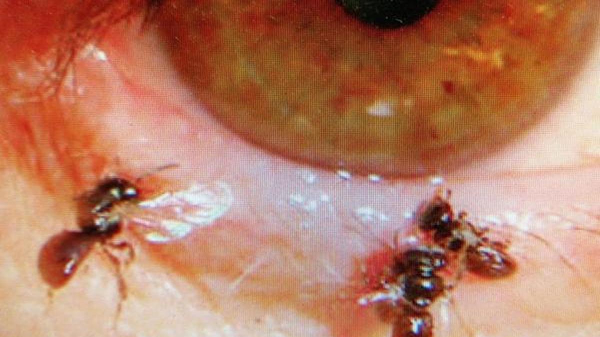 Eye'll bee damned: woman finds insects in eye - The Hindu