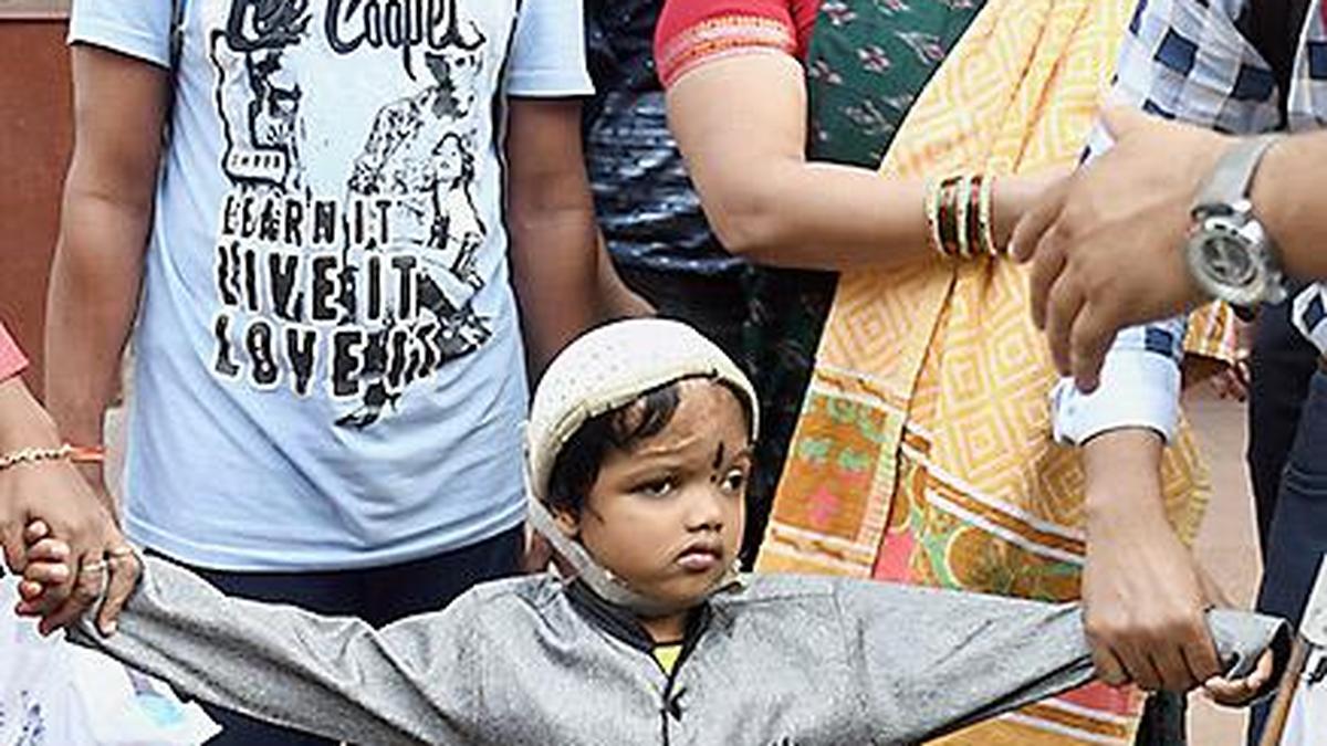 Craniopagus twins arrive in Odisha, admitted in hospital - The Hindu