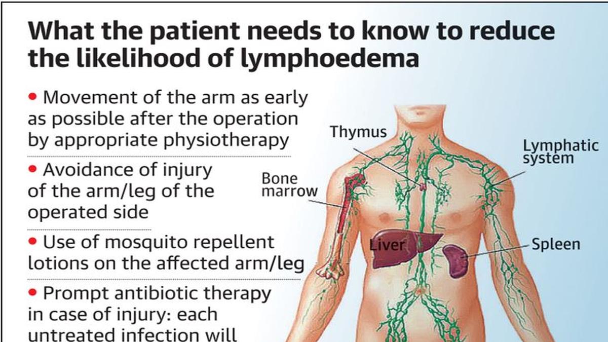 Lymphedema: Arms that swell post the battle with breast cancer - The Hindu
