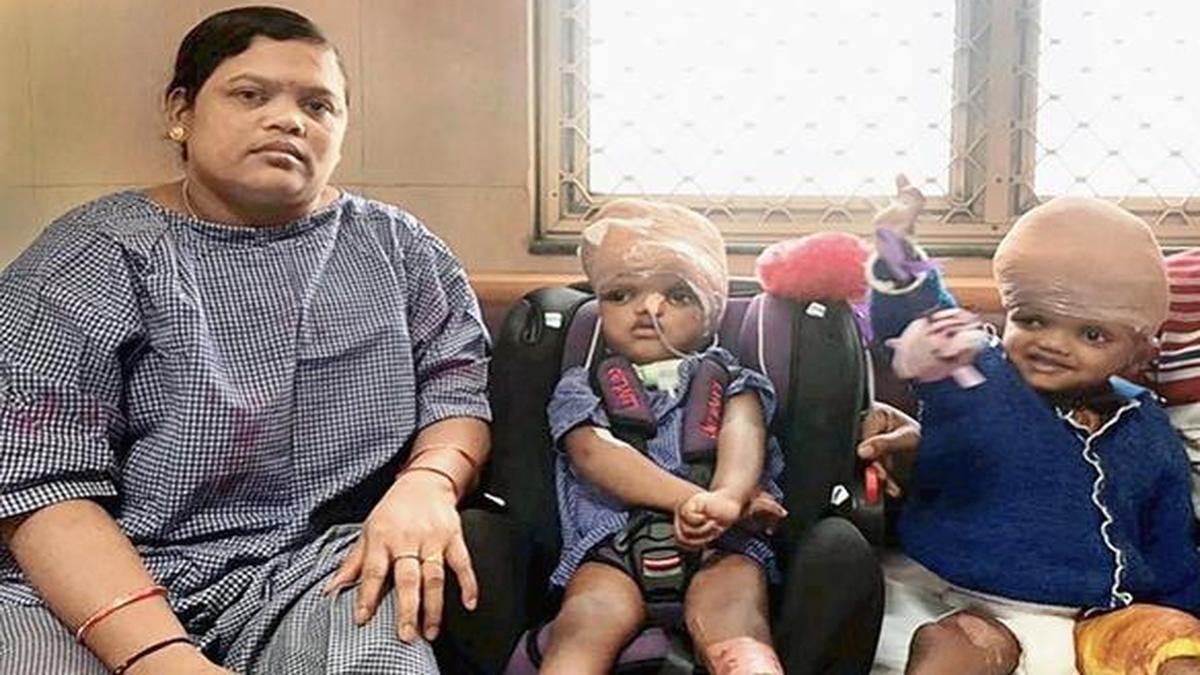 Craniopagus twins head home - The Hindu