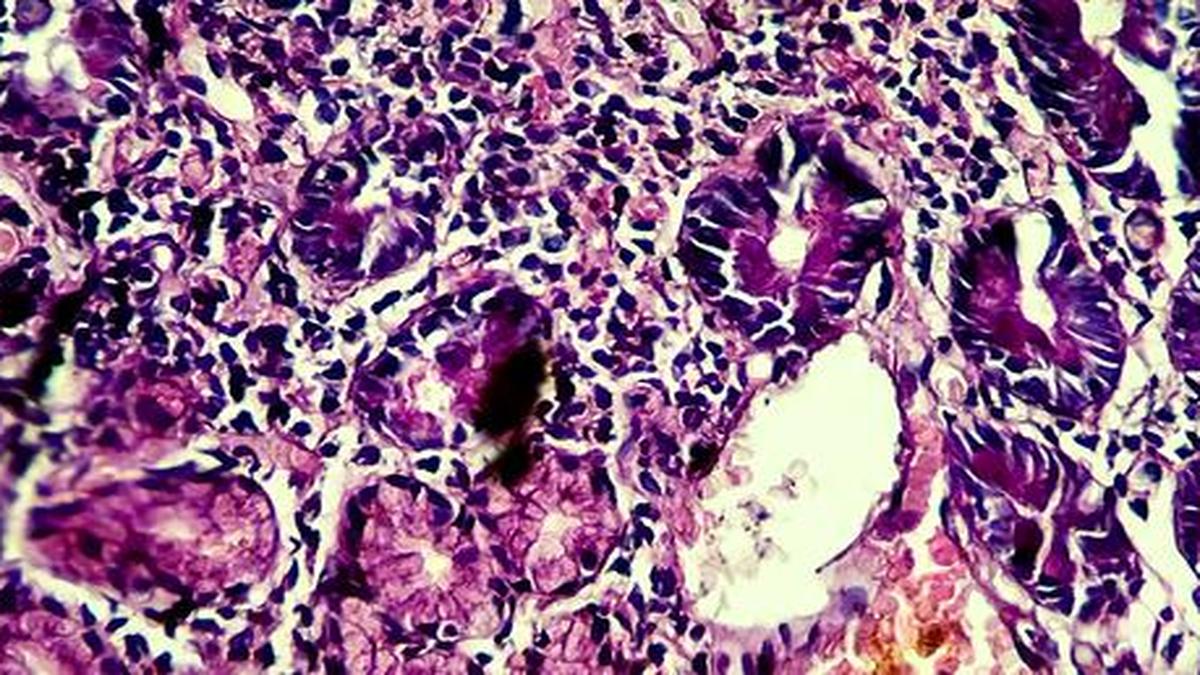 AI tool to simplify identification of cancerous tissue in tumours - The ...