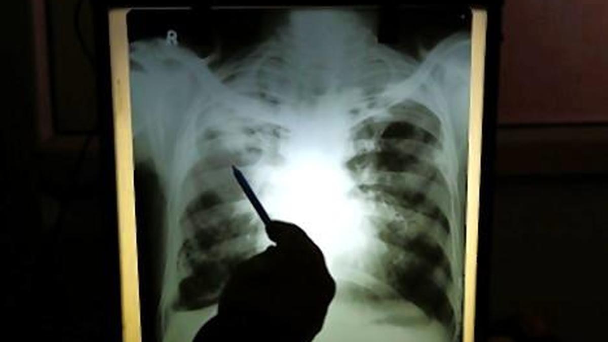 Tall claims on killing tuberculosis - The Hindu