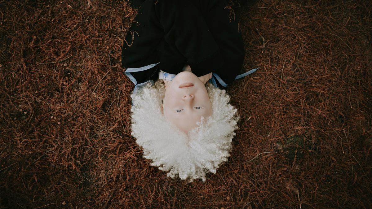 Understanding albinism - The Hindu